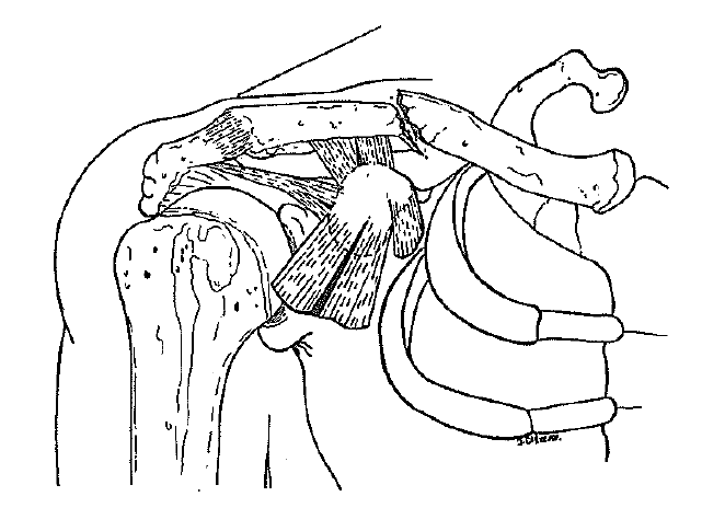 Conceitos-Fratura de Clavícula :: Fraturas