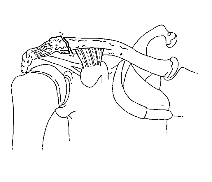 Conceitos-Fratura de Clavícula :: Fraturas