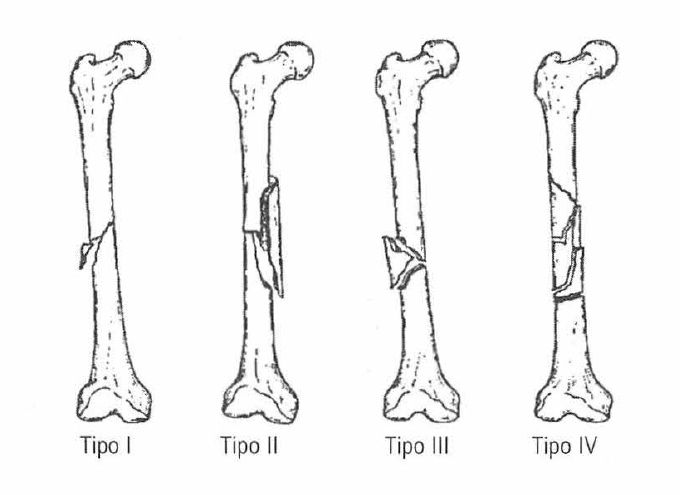 Conceitos- Fratura da Diáfise do Fêmur :: Fraturas