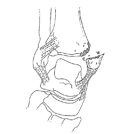 Conceitos-Fratura de Maléolo Medial :: Fraturas